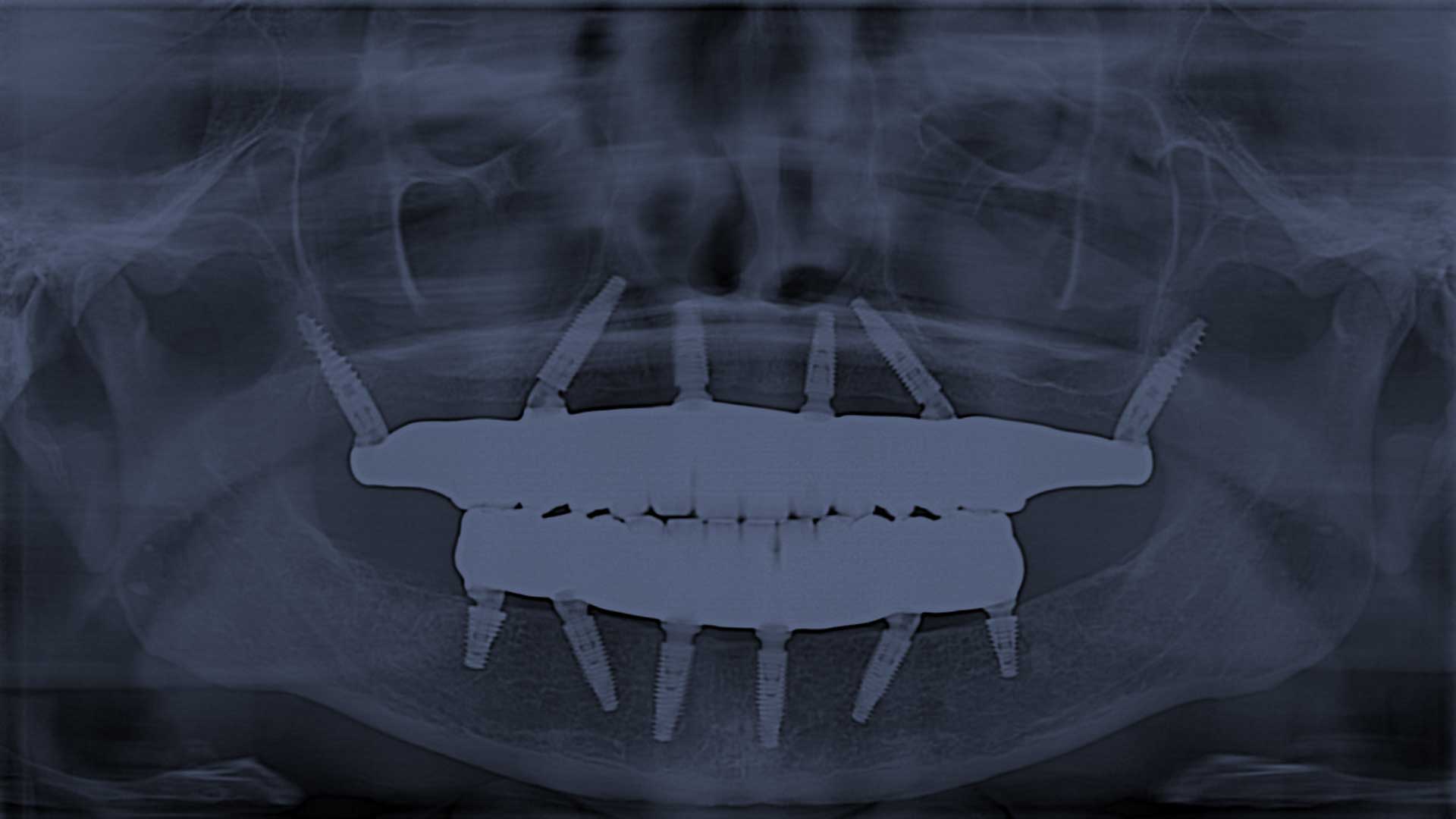 Resources • Dental Implant Education | All-On-X Masterclass